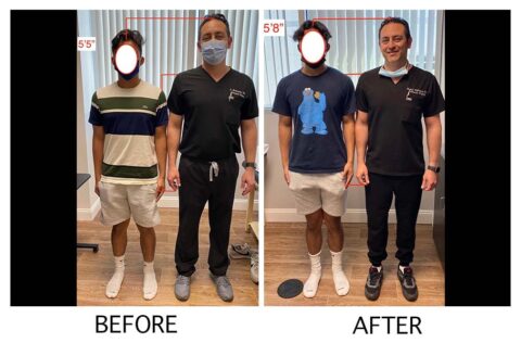 Height Lengthening Surgery Before & After Gallery - Height Lengthening