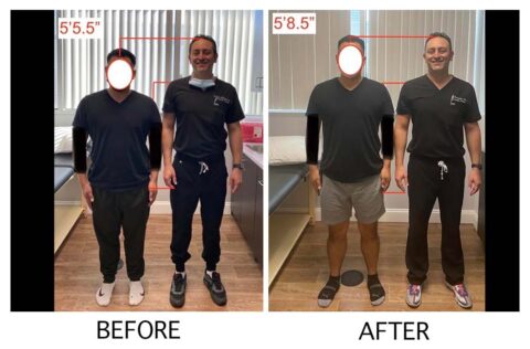 Height Lengthening Surgery Before & After Gallery - Height Lengthening