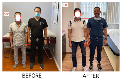 Height Lengthening Surgery Before & After Gallery - Height Lengthening