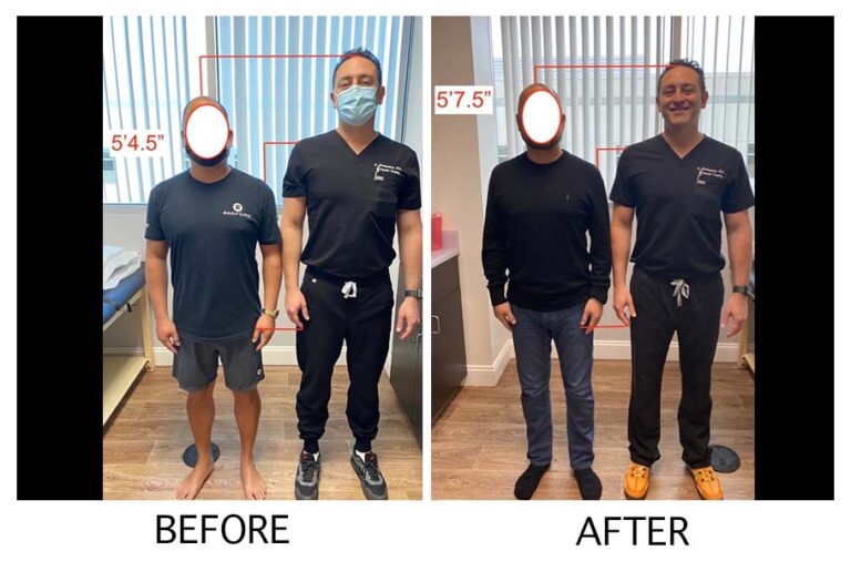 Before & After Gallery - Height Lengthening