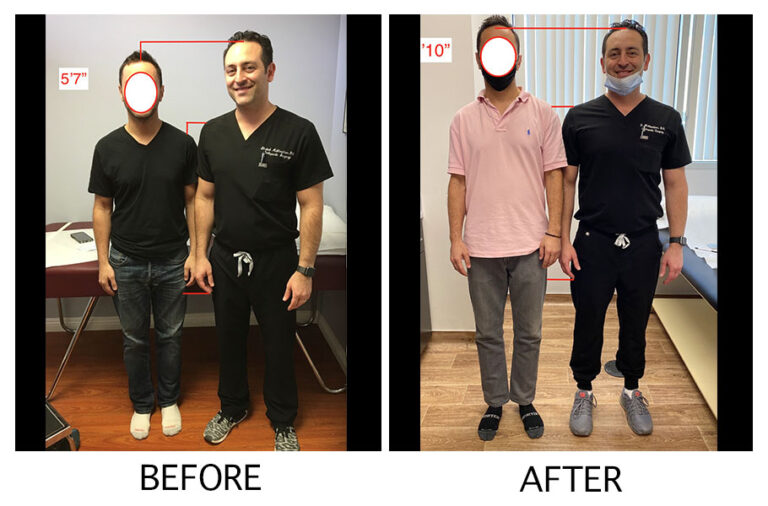 Before & After Gallery - Height Lengthening