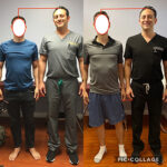 Height Lengthening Surgery Before & After Gallery - Height Lengthening