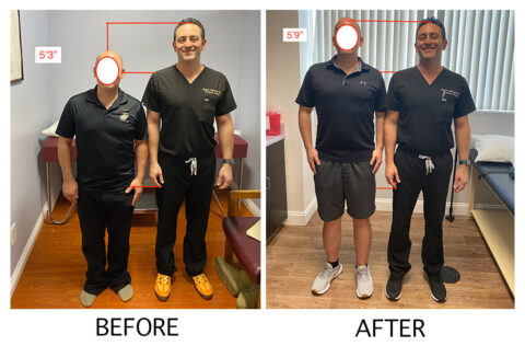 Height Lengthening Surgery Before & After Gallery - Height Lengthening