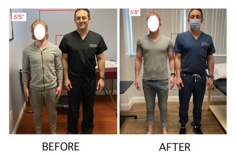 Height Lengthening Surgery Before & After Gallery - Height Lengthening