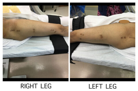 Height Lengthening Surgery Before & After Gallery - Height Lengthening