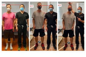 Before & After Gallery - Height Lengthening