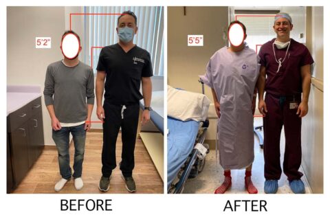 Height Lengthening Surgery Before & After Gallery - Height Lengthening