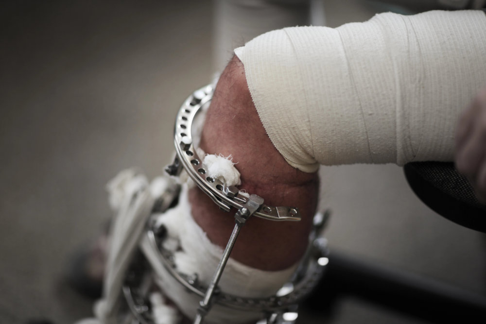 PRECICE Nail for Limb Lengthening | Height Lengthening